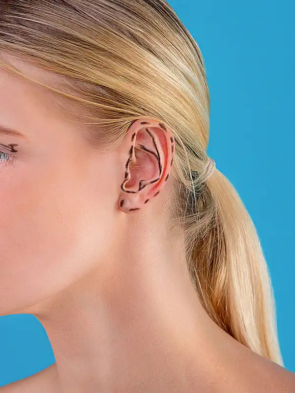 Otoplasty In Turkey | PlaSurgery